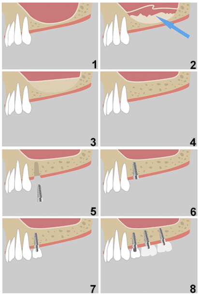 Maxillary sinus bone graft : VC Dental
