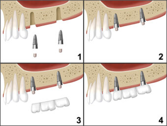 Implant-Supported Dental Bridges, Gosford: VC Dental