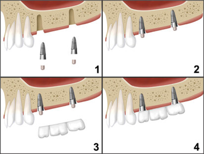 Implant-Supported Dental Bridges, Gosford: VC Dental