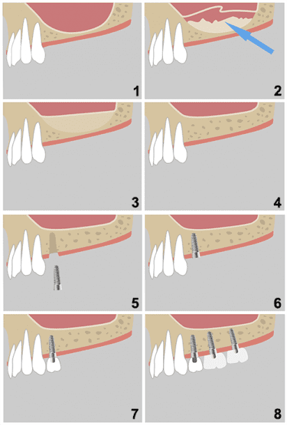 Sinus Lift - Dentist in Gosford, Central Coast, 7 Days: VC Dental
