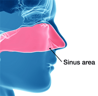 Sinus Lift - Dentist in Gosford, Central Coast, 7 Days: VC Dental