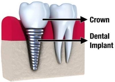Dental Crowns: Everything you need to know : VC Dental