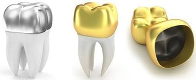 Dental Crowns: Everything you need to know : VC Dental