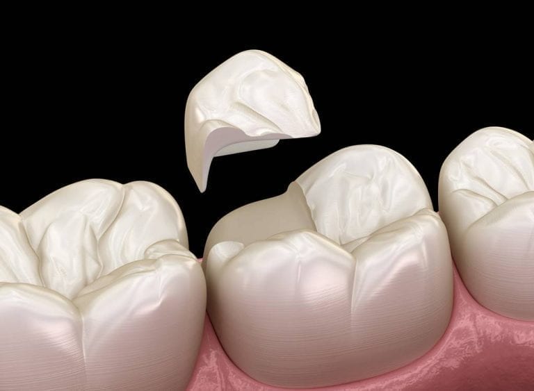 Dental Crowns: Everything you need to know : VC Dental
