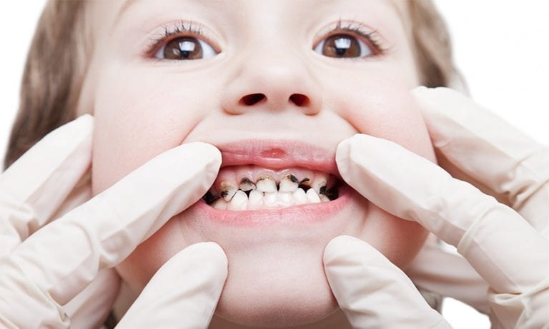 Early Childhood Caries : VC Dental