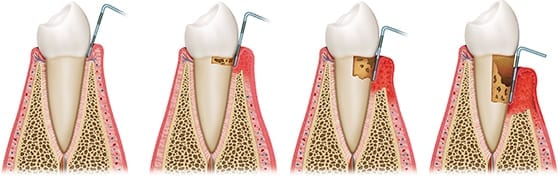 Periodontitis the 6th most prevalent condition in the world : VC Dental